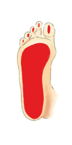 Diagnose Senkfuß | Sanitätshaus Förster